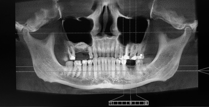 Fogászati ciszta eltávolítása fájdalommentesen? Mi a fog eredetű ciszta ...